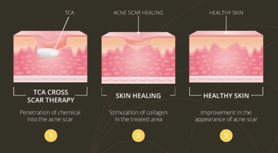 Acne Scars Management & TCA Cross - E&G Aesthetic Institute